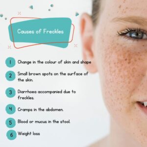 What are freckles? Causes, symptoms and treatment options - SkinQure